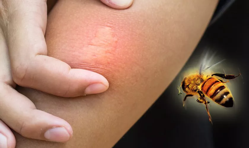 METEOFOR: Ce trebuie să faci dacă te înțeapă o albină